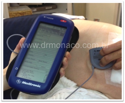 Infusão Intratecal de Fármacos - Bomba de Morfina